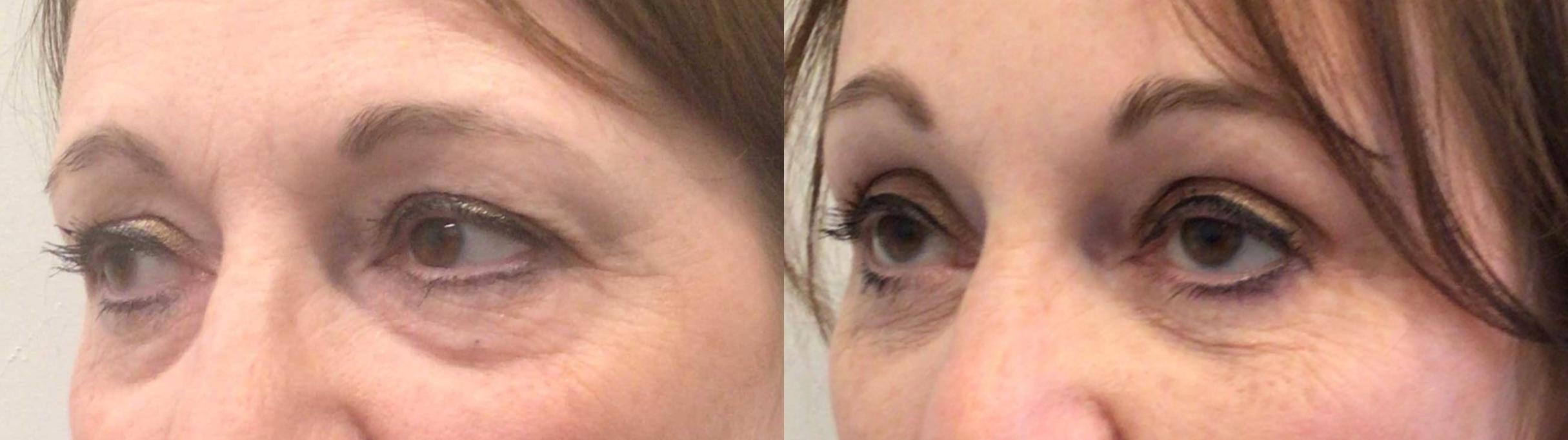 Brow Lift Before and After Pictures Case 444 | Albany, Latham ...
