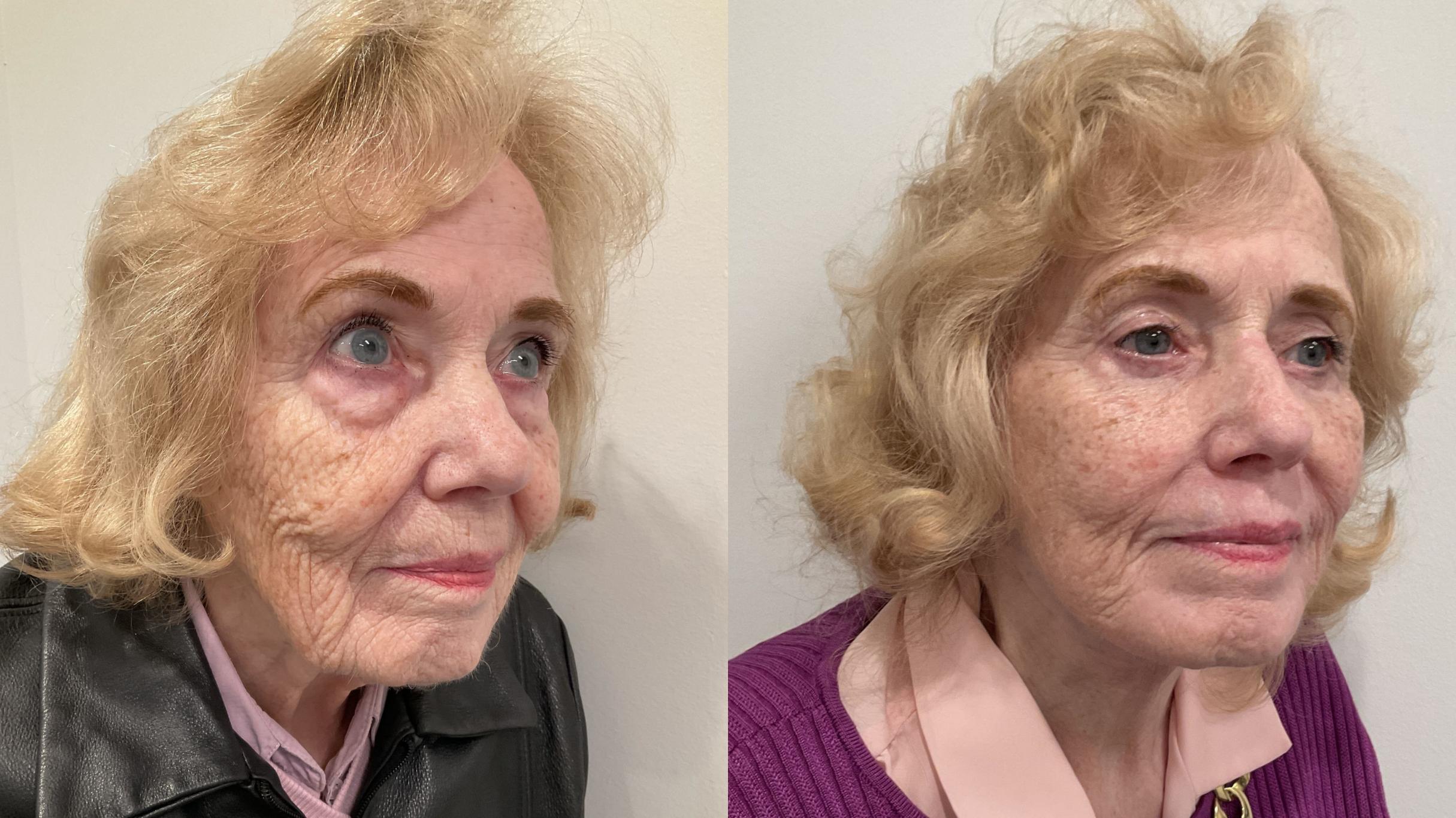 Facelift Before and After Pictures Case 470 | Albany, Latham & Saratoga ...